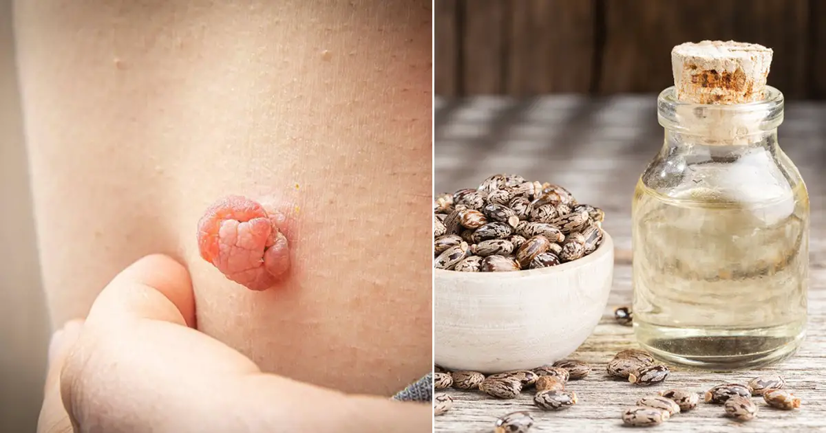 Does Castor Oil Remove Skin Tags? - Castor Oil Guide Does Castor Oil Remove Skin Tags? - Castor Oil Guide