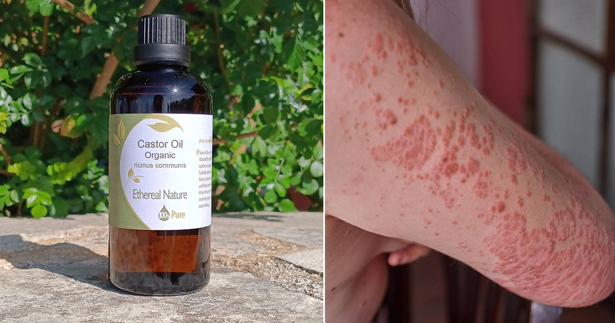How to Use Castor Oil for Psoriasis - Castor Oil Guide